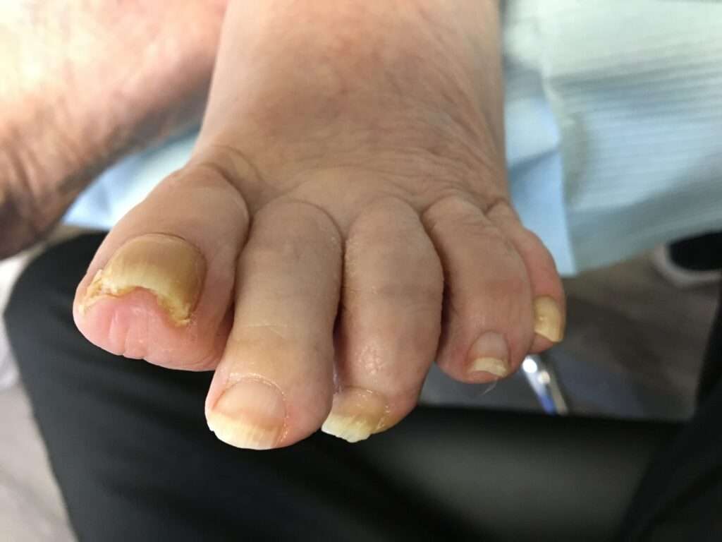 Ingrown Toenail: 5 Treatment options